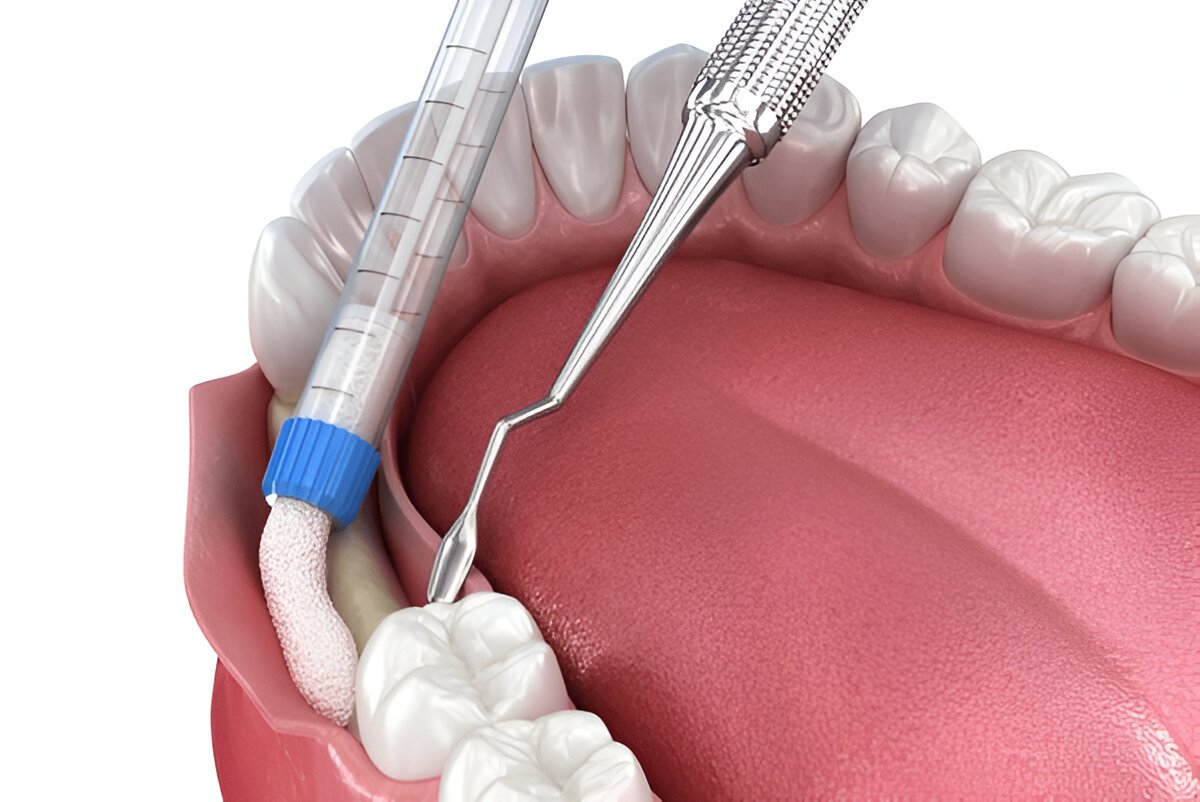 Bone Grafting Near Me in San Antonio & New Braunfels, TX